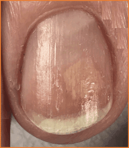 Difference Between Fungal Nail Infections and Nail Psoriasis ...