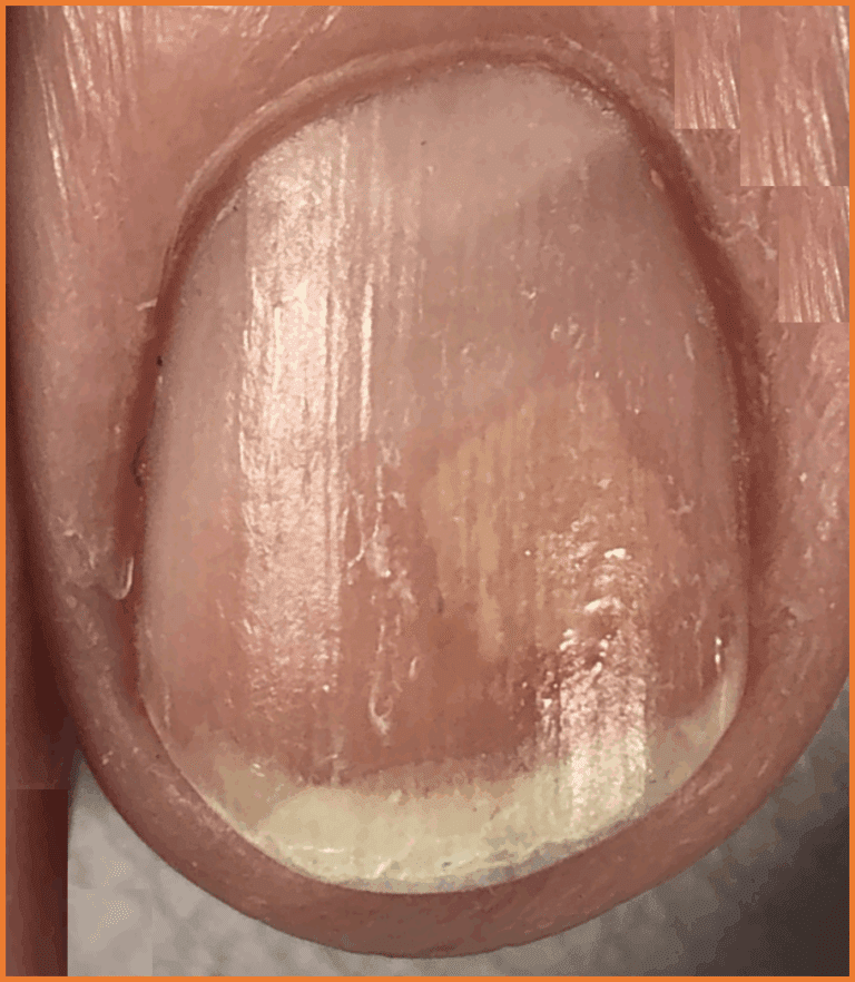 Difference Between Fungal Nail Infections and Nail Psoriasis ...