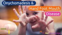 Onychomadesis & Hand Foot Mouth Disease - NailKnowledge