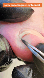 Ingrowing or Ingrown Toenail – Causes, Symptoms and Care Advice ...