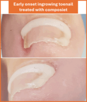 Ingrowing or Ingrown Toenail – Causes, Symptoms and Care Advice ...