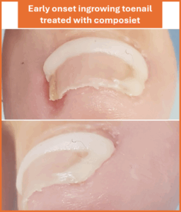 Ingrowing or Ingrown Toenail – Causes, Symptoms and Care Advice ...