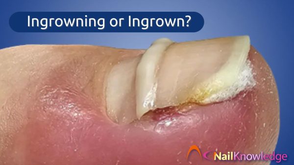 Ingrowing or Ingrown Toenail – Causes, Symptoms and Care Advice ...