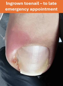 Ingrowing or Ingrown Toenail – Causes, Symptoms and Care Advice ...